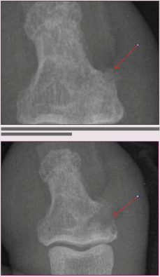 Osteomyelitis: Keys To Diagnosis And Treatment