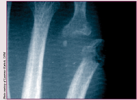 Osteomyelitis: Keys To Diagnosis And Treatment