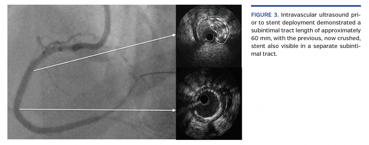 The Difference Between Success and Failure: Subintimal Stenting Around ...