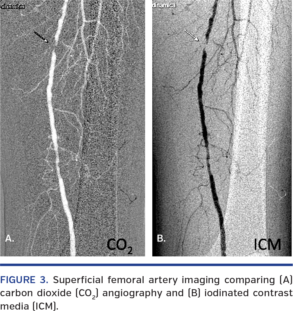 Automated Carbon Dioxide Digital Angiography for Lower-Limb Arterial ...