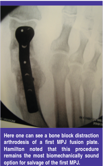 Calcaneal Autograft: Can It Facilitate Salvage Of A Failed First MPJ ...