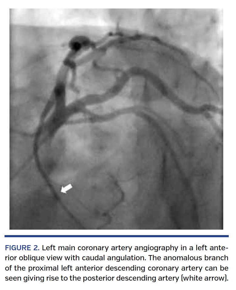 Posterior Descending Coronary Artery Arising From a Septal Branch of ...