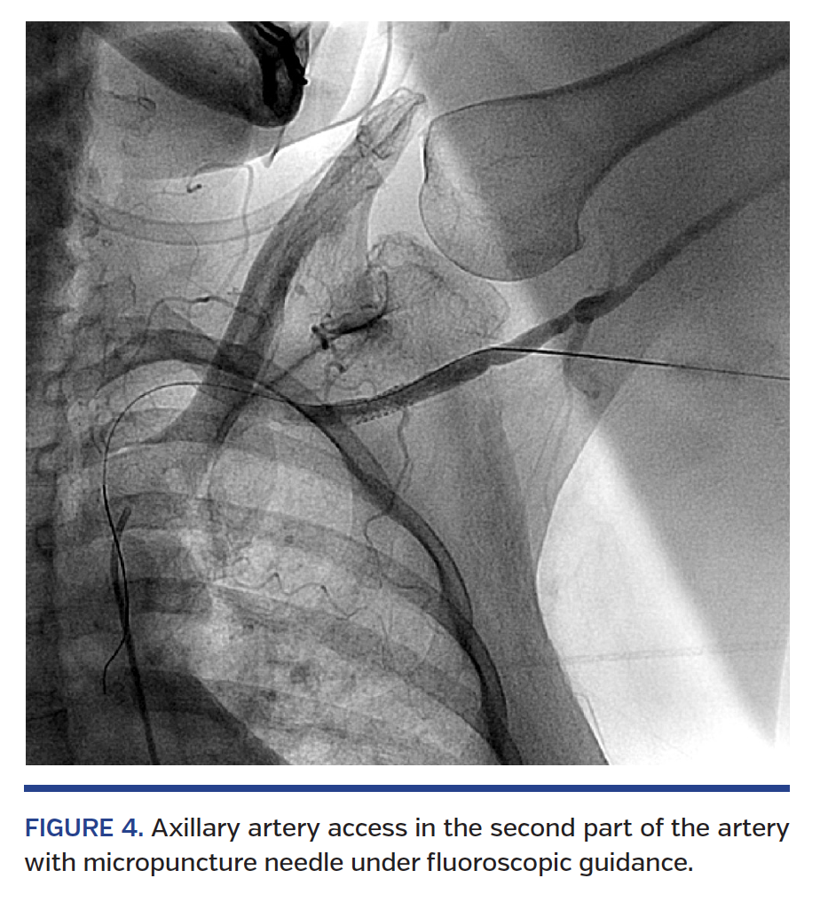 Totally Percutaneous Insertion and Removal of Impella Device Using ...