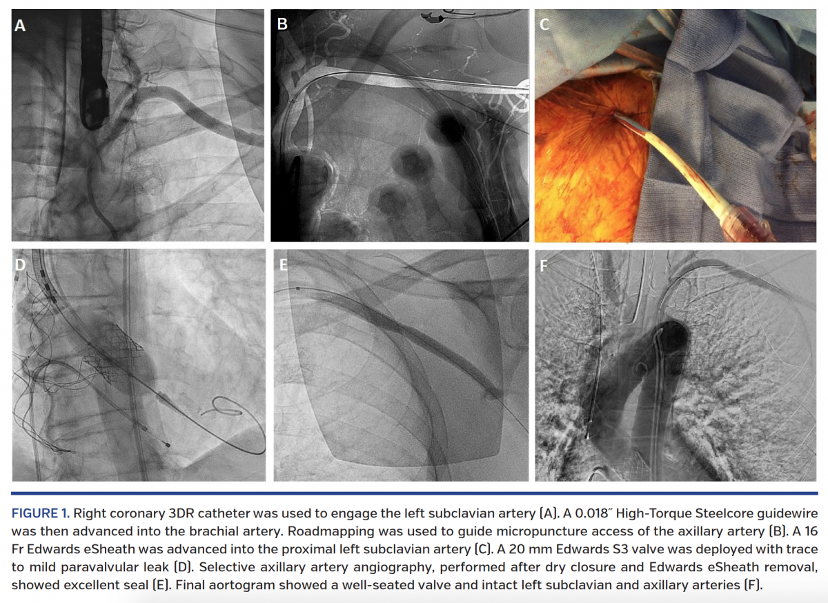Percutaneous Transaxillary Transcatheter Aortic Valve Replacement