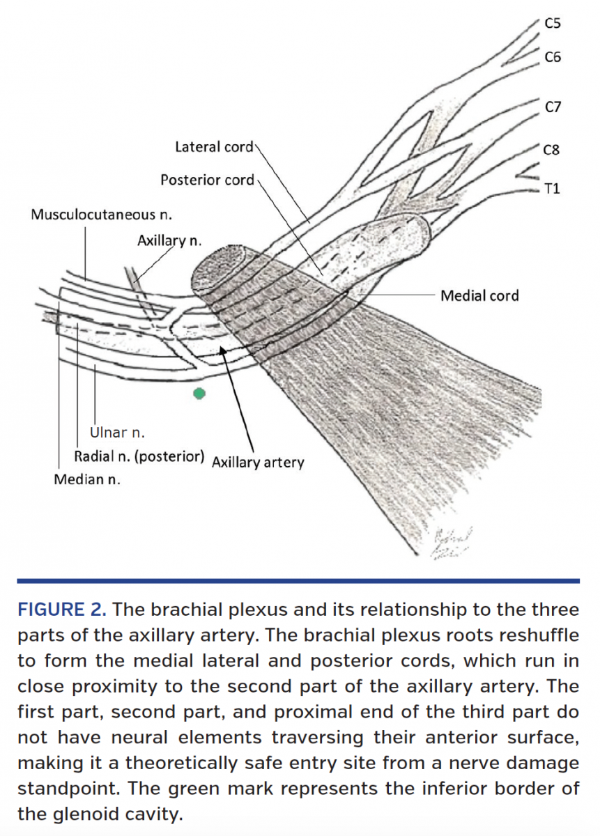 Suggested Bony Landmarks for Safe Axillary Artery Access