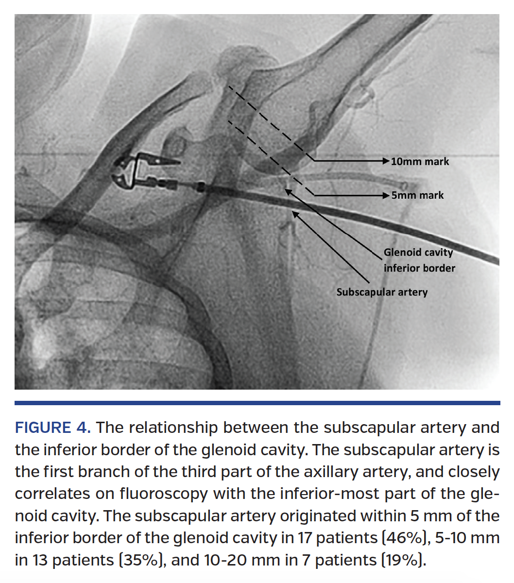 Suggested Bony Landmarks for Safe Axillary Artery Access