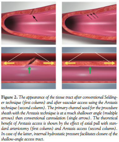 Use of a Novel Access Technology for Femoral Artery Catheterization ...