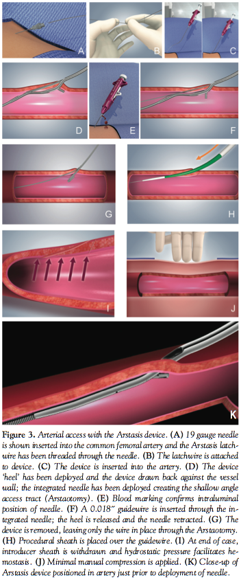 Use of a Novel Access Technology for Femoral Artery Catheterization ...