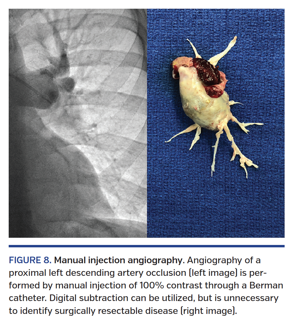 Optimal Technique for Performing Invasive Pulmonary Angiography for ...