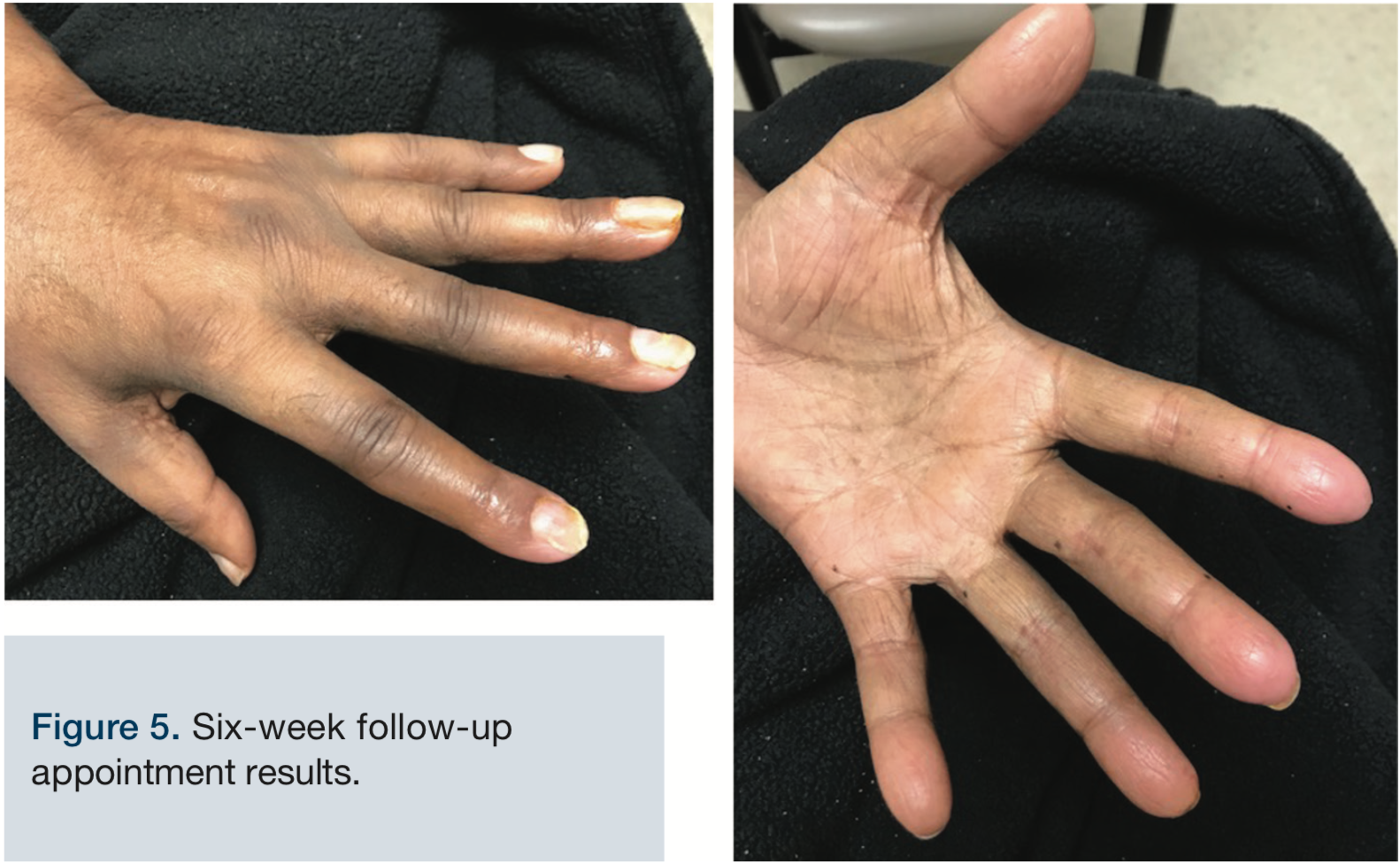Treatment of Critical Hand Ischemia via Orbital Atherectomy and Balloon ...