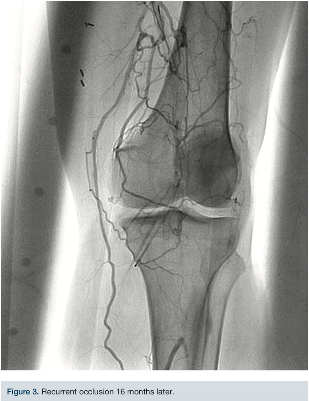 Interventional Therapy of Complex Superficial Femoral Artery Disease ...