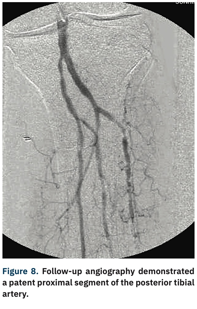 Posteriortibialarteryangiogram