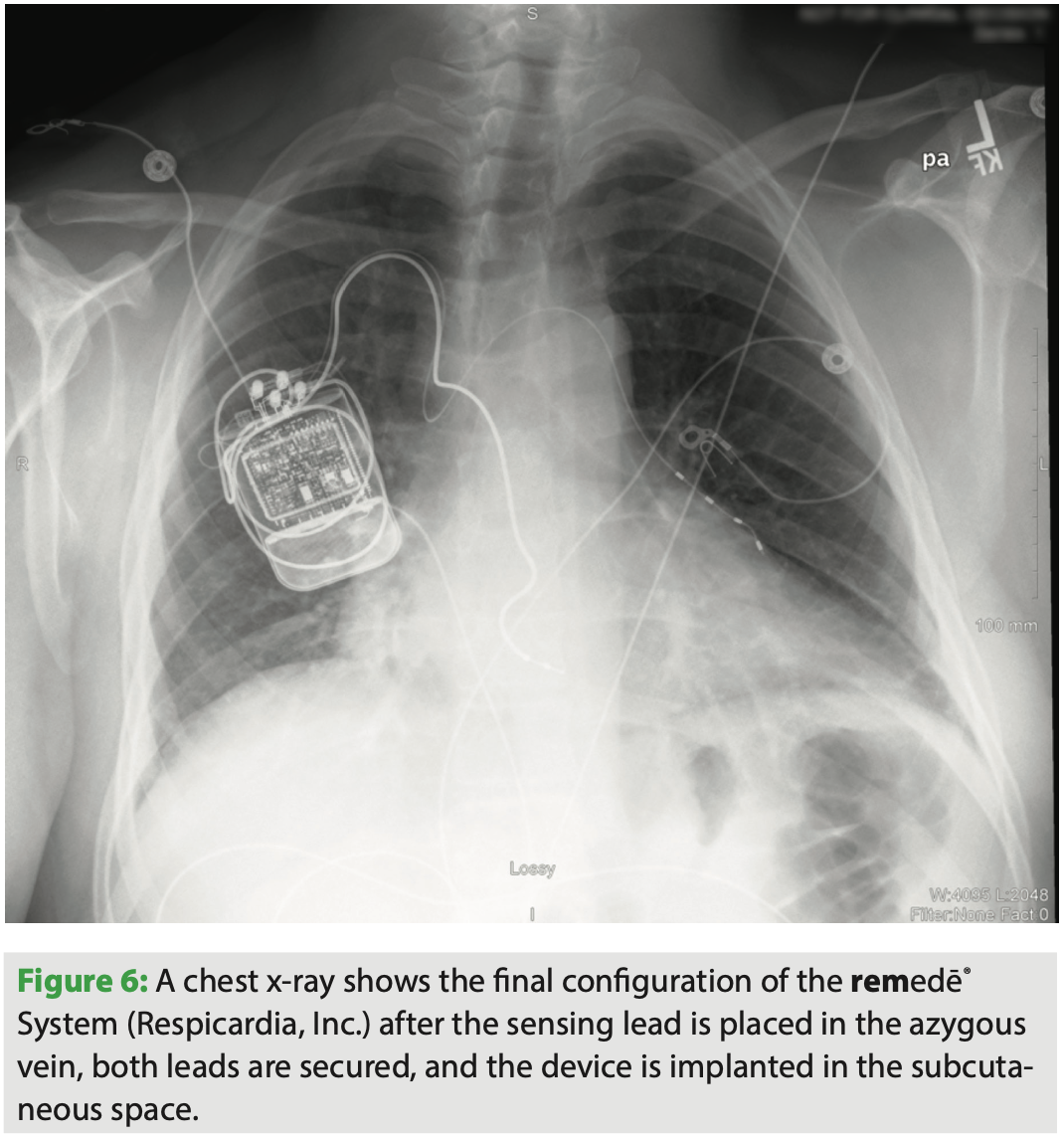 Phrenic Nerve Pacing: A Revolution in the Treatment of Central Sleep Apnea