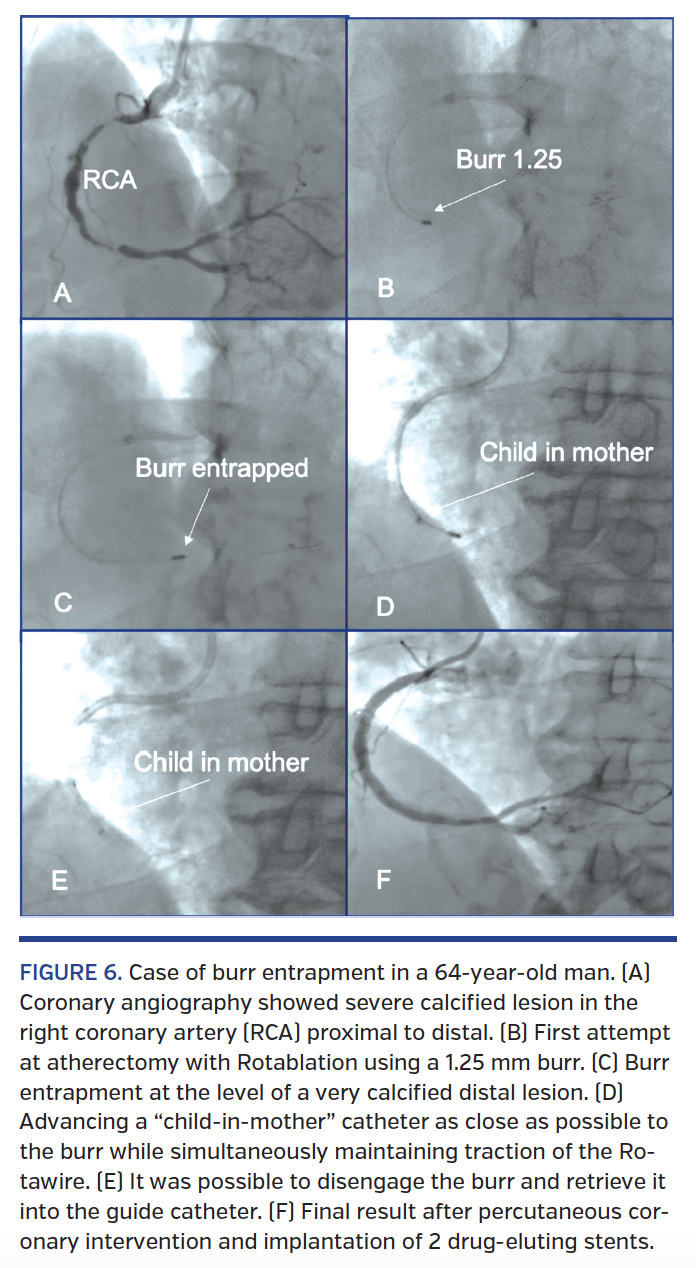 Tips and Tricks for Rotational Atherectomy