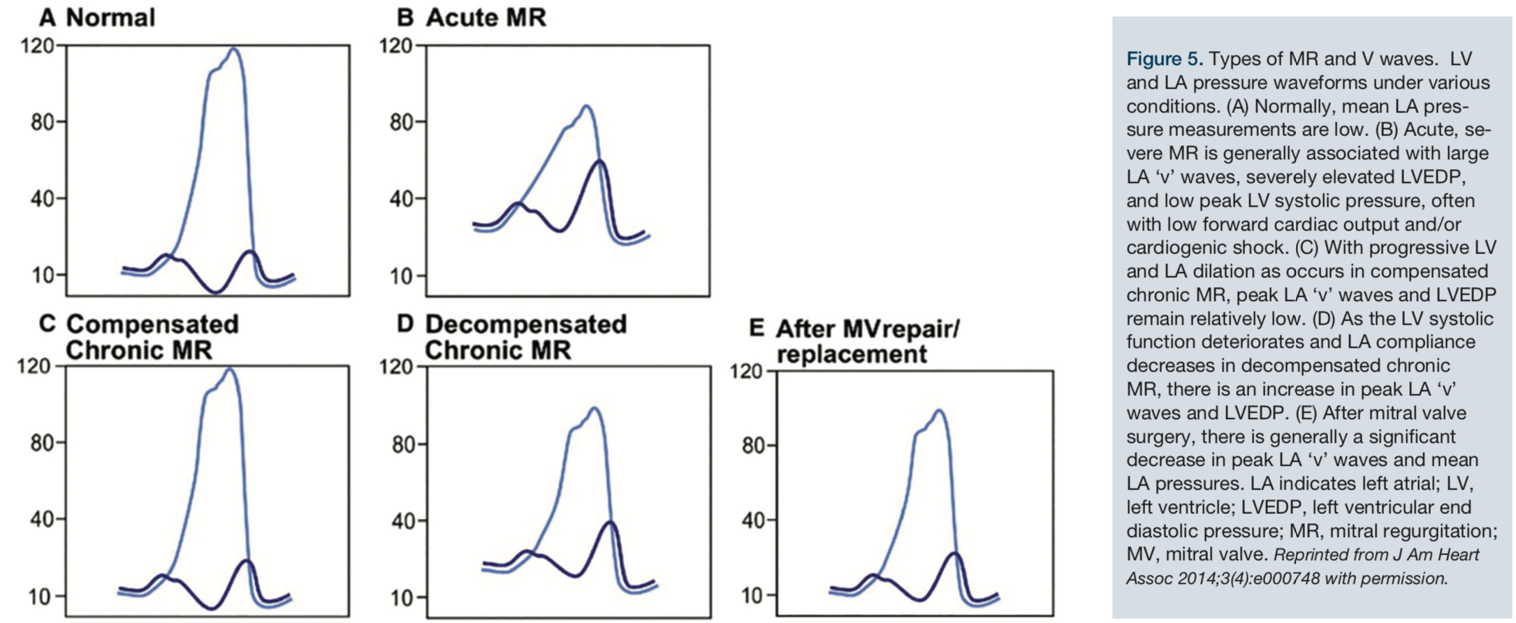 A Brief Review of Hemodynamics for Structural Interventions Part 1 ...