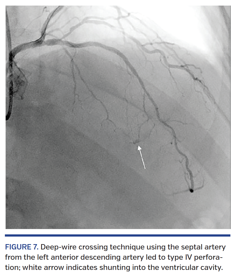 The Deep-Wire Crossing Technique: A Novel Method for Treating Balloon ...