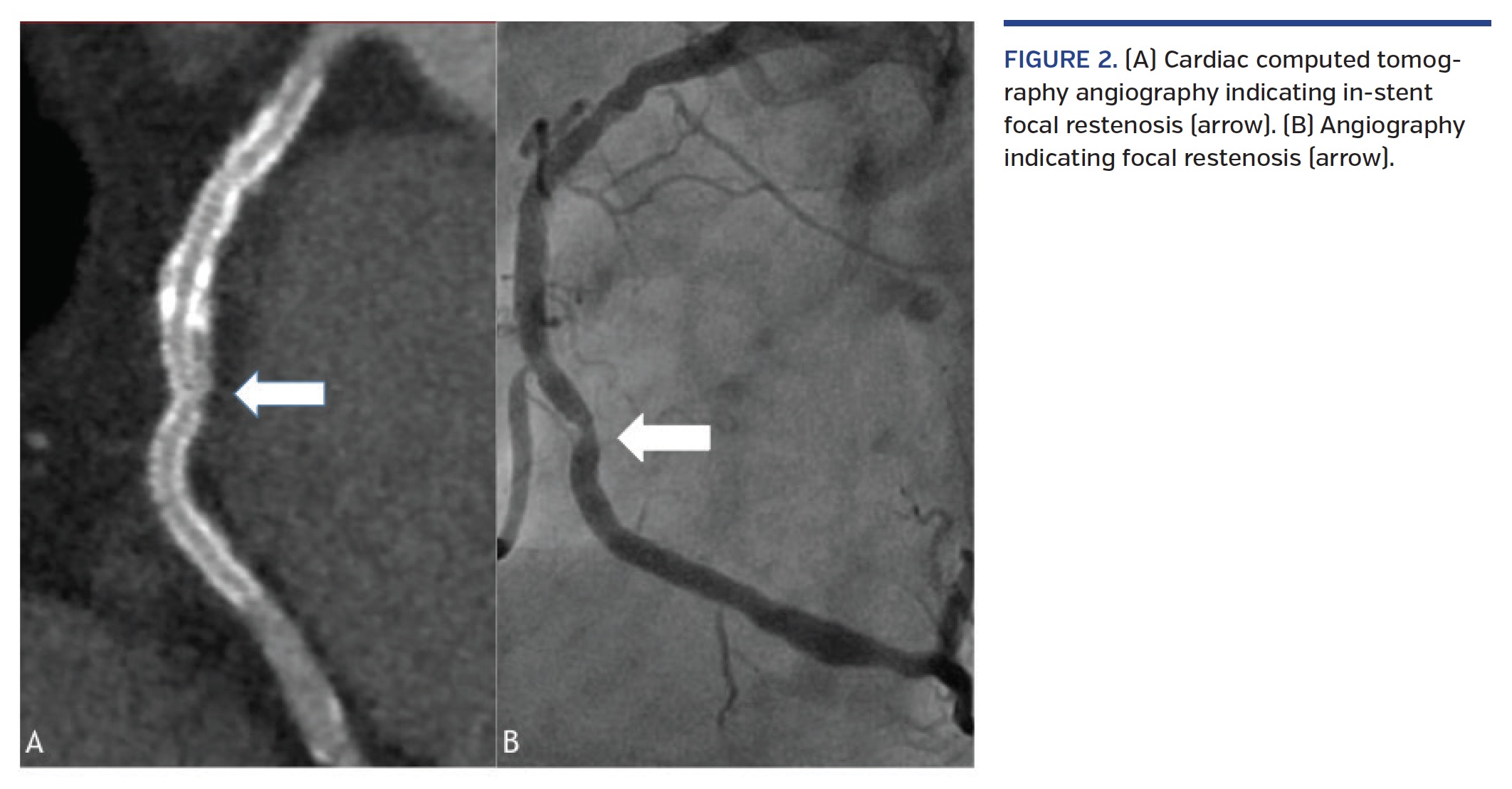 Coronary Stent Fracture: Still a Cause of Stent Failure