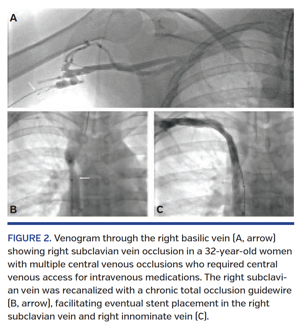 Upper-Extremity Venous Access for Children and Adults in Pediatric ...