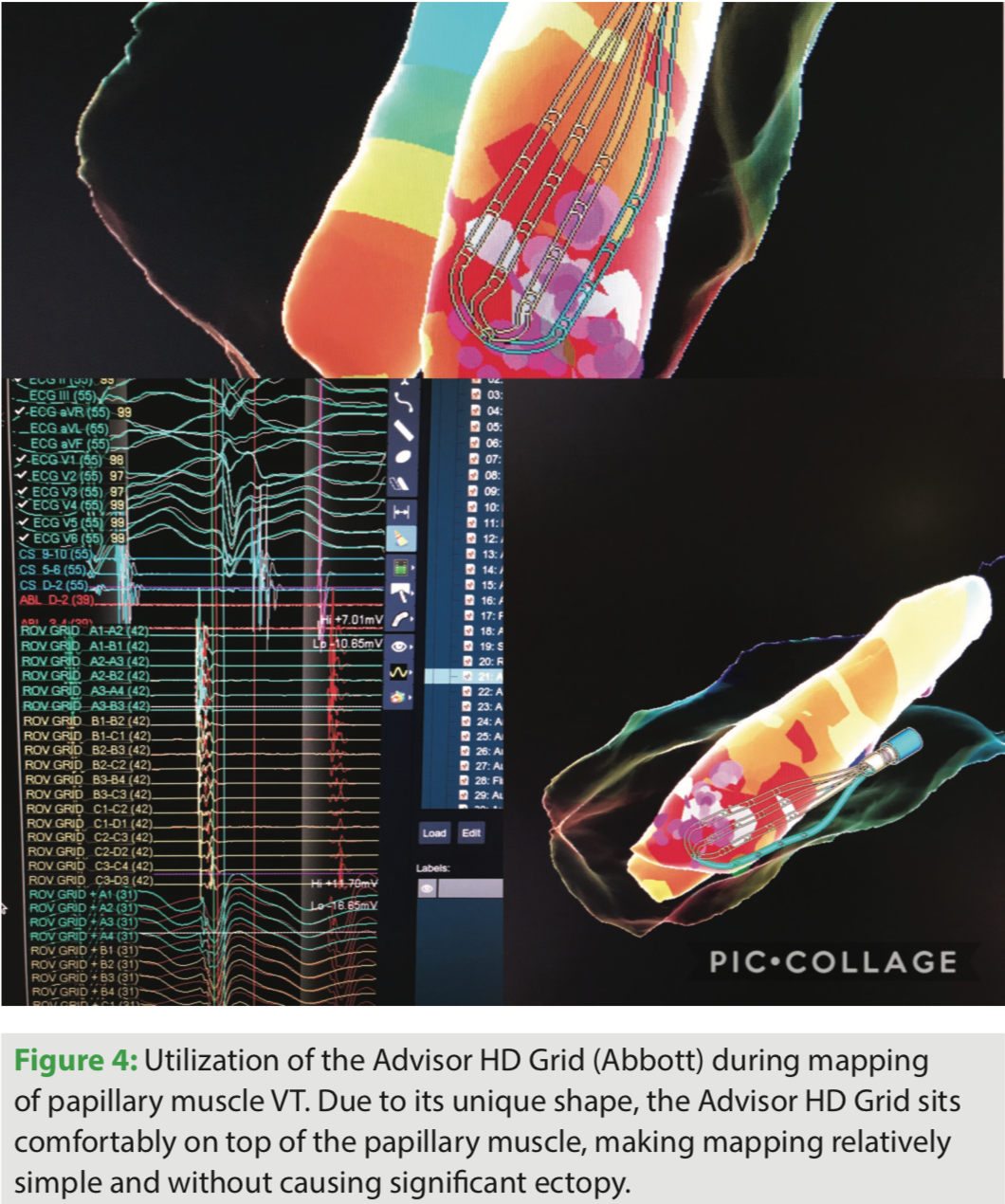 Multi-Electrode Mapping Utilizing a High-Density Mapping Catheter for ...