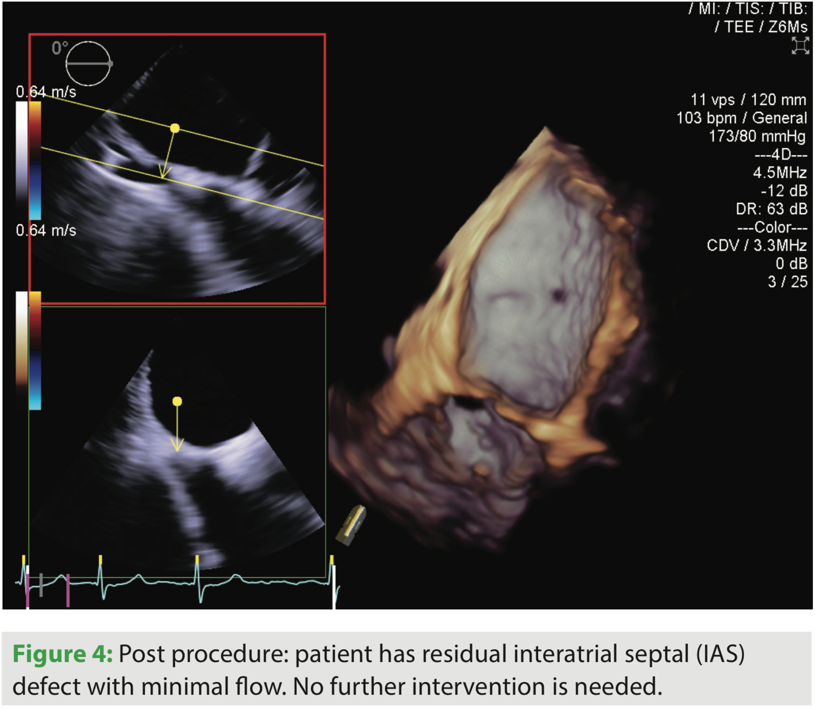 Successful LAAC Using 3D TEE