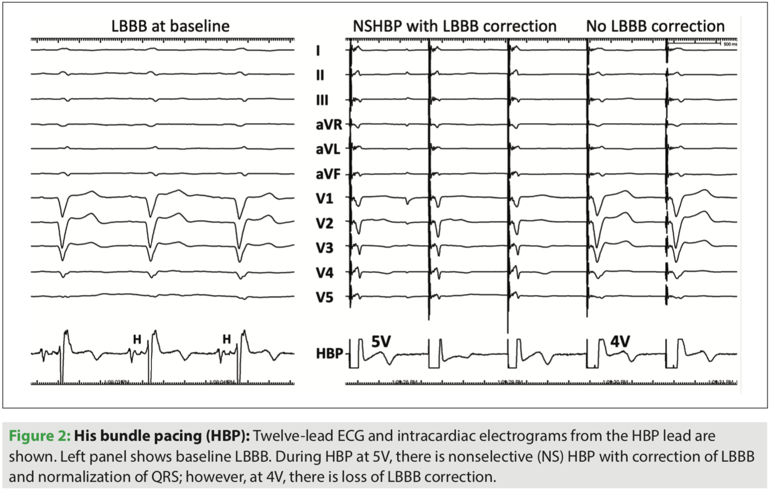 Pacing Beyond the Site of Block: Left Bundle Branch Area Pacing in a ...