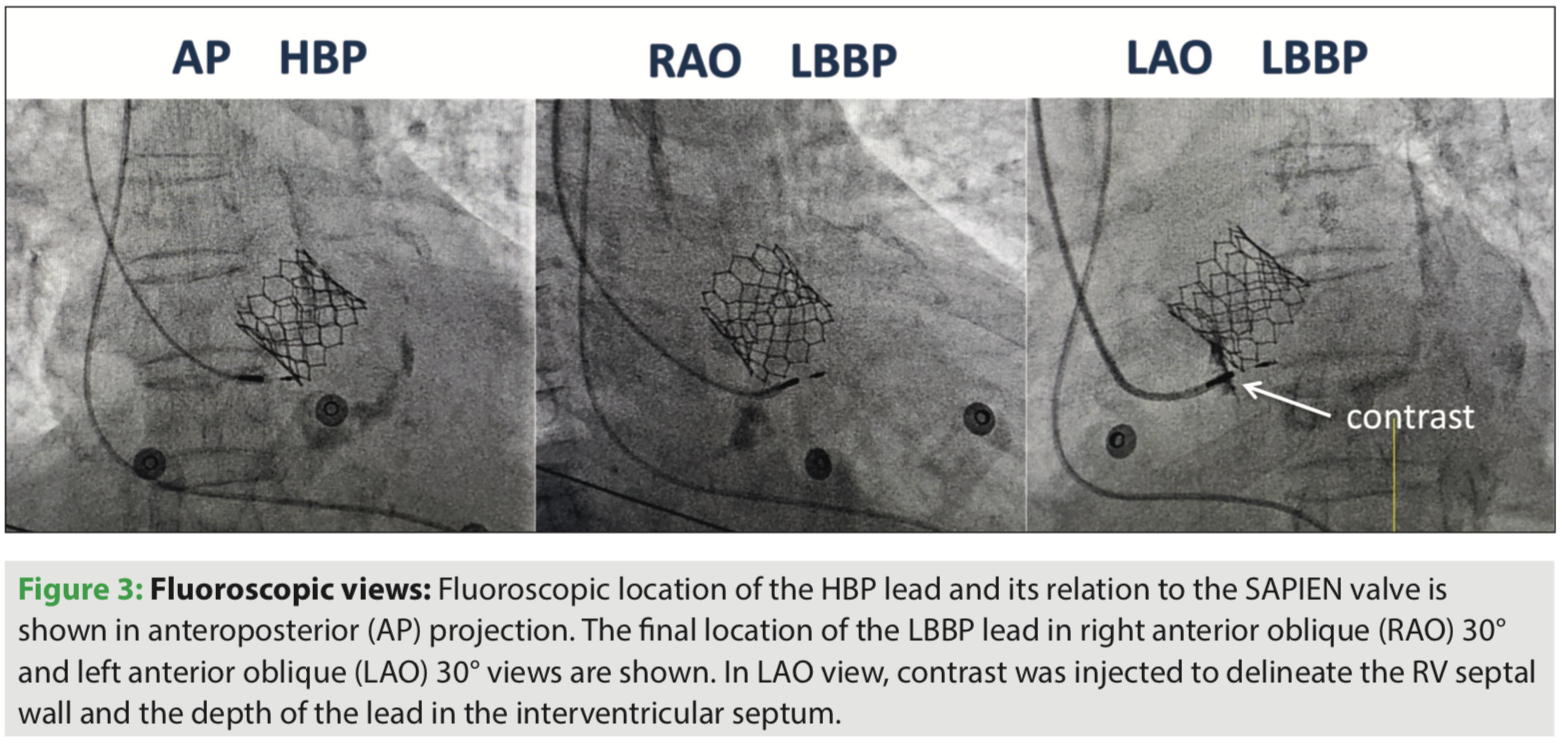 Pacing Beyond the Site of Block: Left Bundle Branch Area Pacing in a ...