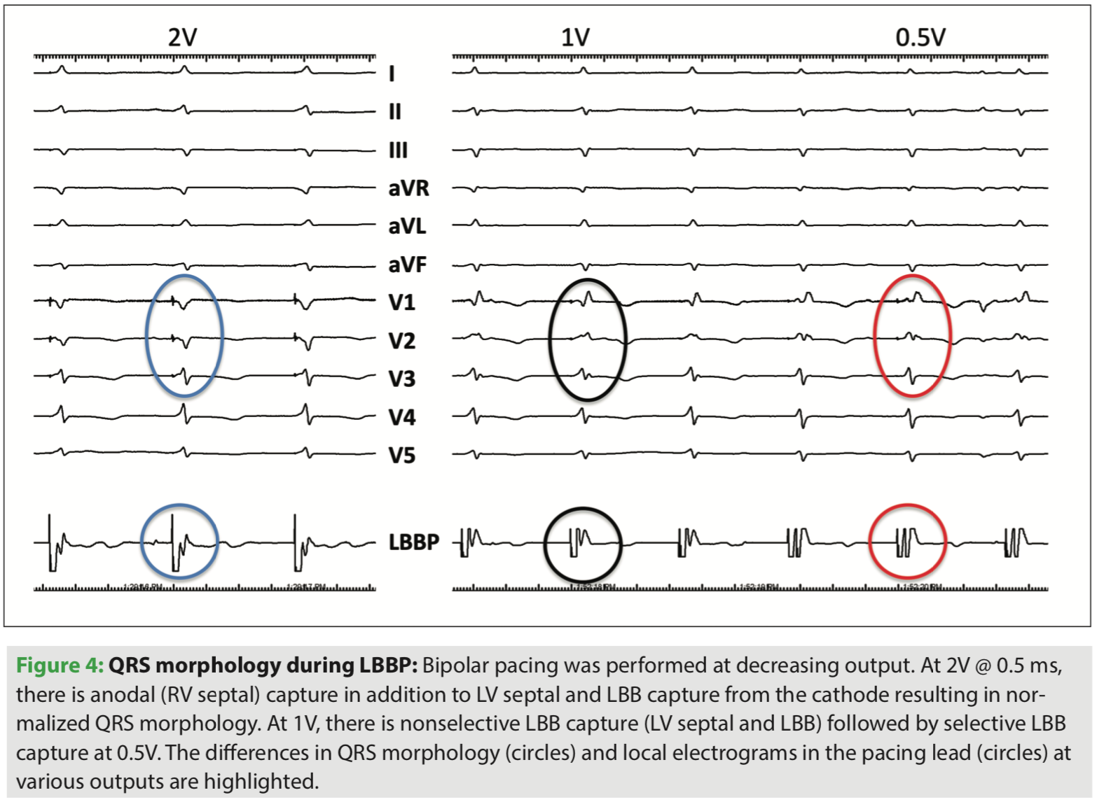 Pacing Beyond the Site of Block: Left Bundle Branch Area Pacing in a ...