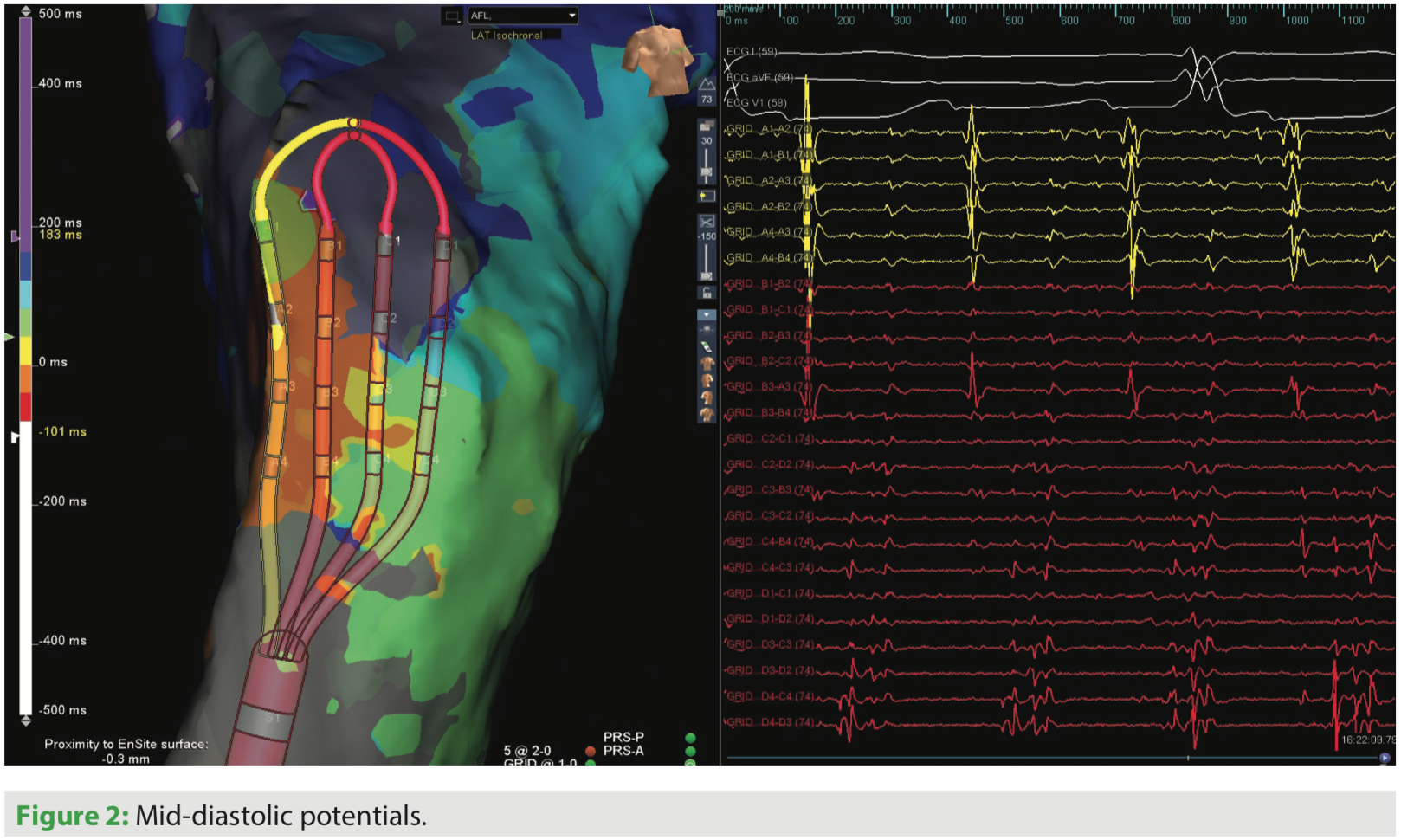 Achieving Efficient Workflow in the EP Lab With High-Density Mapping of ...