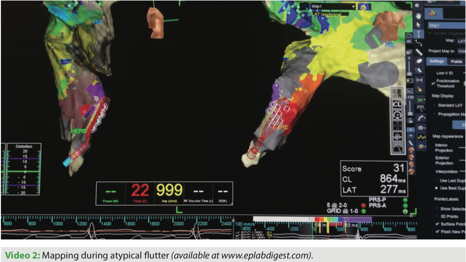 Achieving Efficient Workflow in the EP Lab With High-Density Mapping of ...
