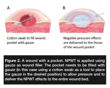 Individualizing the Use of Negative Pressure Wound Therapy for Optimal ...