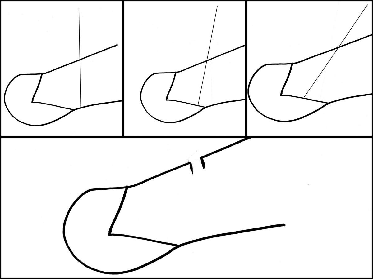 Quick Pearls On Fixation For Distal Chevron Osteotomies