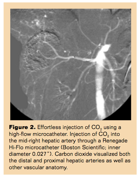 Carbon Dioxide Imaging in Interventional Oncology: Preserving Renal ...