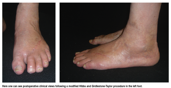 Essential Insights On Tendon Transfers For Digital Dysfunction