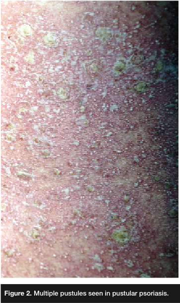 Cardiovascular Health for Patients with Psoriasis: A Pr√©cis for Front ...