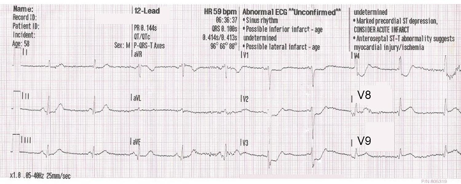 Infarction Myocardial Posterior Inferior Ecgpedia Ekg Stemi Wikidoc Mi ...