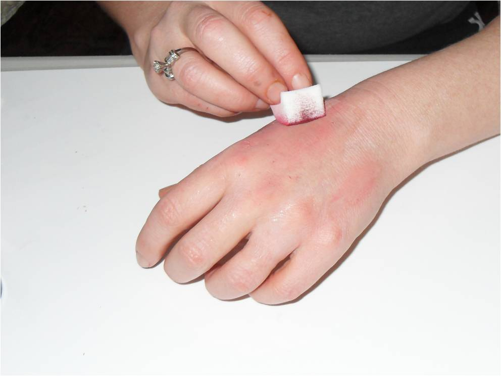 Wound of the Month: 2nd Degree Burns (Superficial–Partial Thickness)