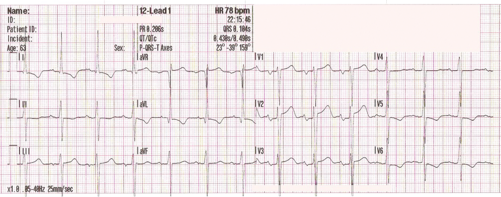 Acute Anterior STEMI: A Challenging Diagnosis
