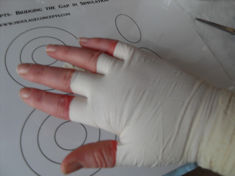 Wound of the Month: Degloving
