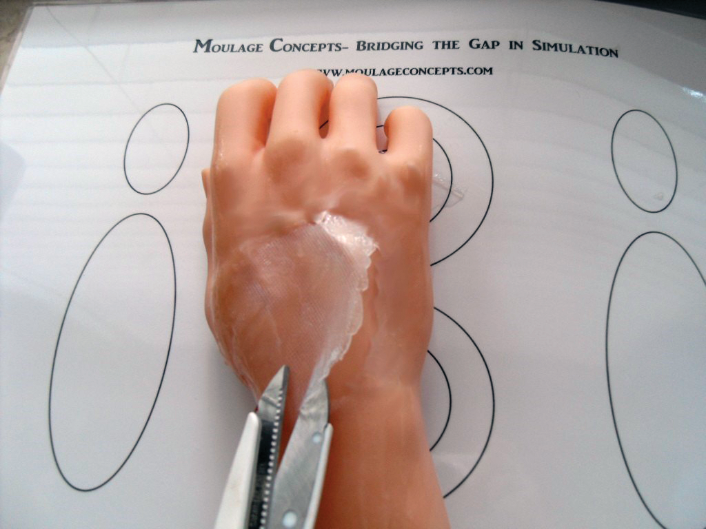 Avulsion Wound Avulsion Wound