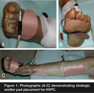 A Retrospective Study of High-Voltage, Pulsed Current as an Adjunctive ...