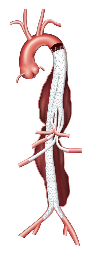 First Patient Treated with Medtronic Valiant TAAA Stent Graft System in ...