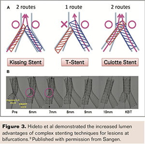 CFA, Profunda, and SFA Disease | Vascular Disease Management