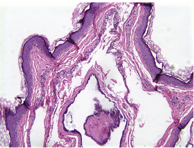 What Are These Cystic Lesions Adjacent to the Eyelids?