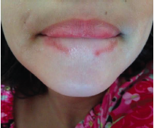 What Is This Hyperpigmented Scaly Linear Change On The Lower Lip?