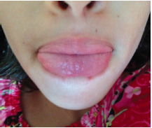 What Is This Hyperpigmented Scaly Linear Change On The Lower Lip?