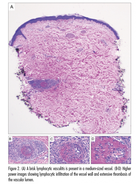 Case: Macular Lymphocytic Arteritis