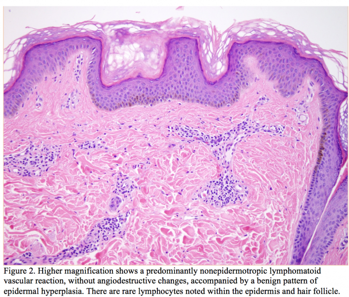 Pautrier Microabscesses Mycosis Fungoides