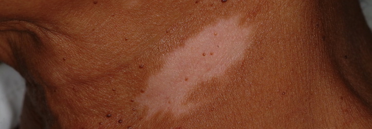 Transplanted Skin Cells Can Provide Lasting Repigmentation of Vitiligo