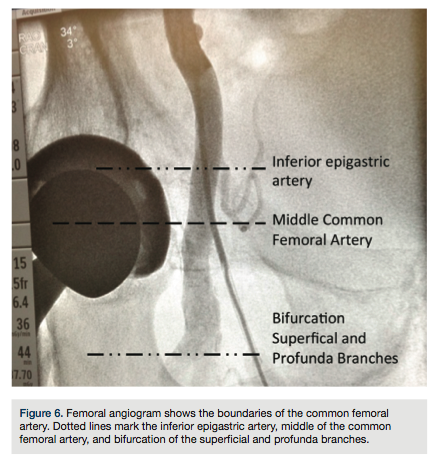 Back to Basics: Femoral Artery Access and Hemostasis
