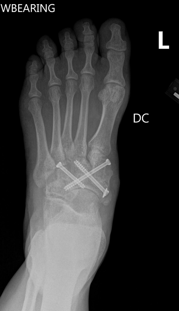 Treating An Active Hiker With A Gastroc Recession And A Midfoot Osteotomy